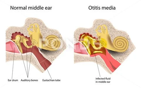 Otitis ear anatomy of the human disease: Graphic #86474281