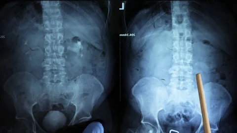 Oxalate stone on x-ray, close-up. x-ray ... | Stock Video | Pond5