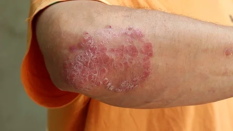 Plaque Psoriasis Stock Footage ~ Royalty Free Stock Videos | Pond5