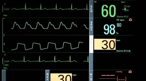 Patient ICU Monitor Flat Lines | Stock Video | Pond5