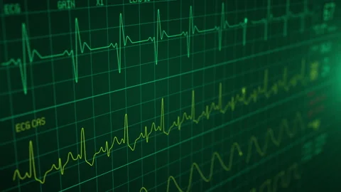 Patient monitor displays vital signs ECG... | Stock Video | Pond5