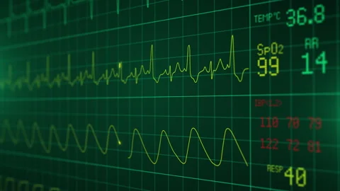Patient monitor displays vital signs ECG... | Stock Video | Pond5