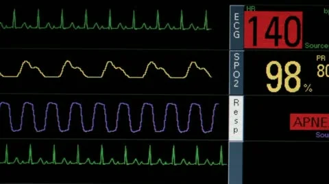 Patient Vital Signs Critical | Stock Video | Pond5