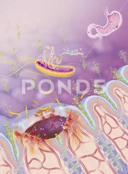Peptic ulcer disease Ulceration of the gastric mucosa with Helicobacter ...