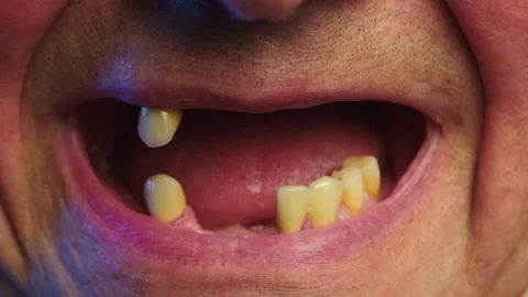 Periodontal disease and missing teeth in... | Stock Video | Pond5