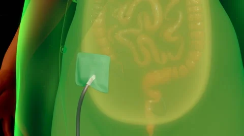 Peritoneal Stock Video Footage | Royalty Free Peritoneal Videos | Pond5