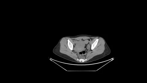PET CT scan image showcasing axial pelvi... | Stock Video | Pond5