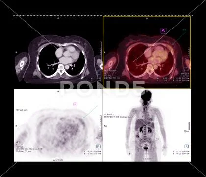 PET CT Scan image of whole body comparison Axial plane in CT scan and PET CT: Graphic #108448037