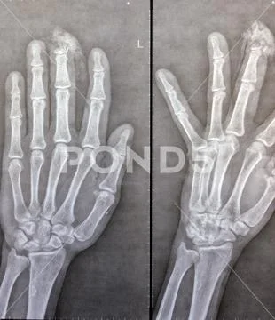 Photograph: Plain X-Ray reveals distal tip amputation of distal phalanx ...