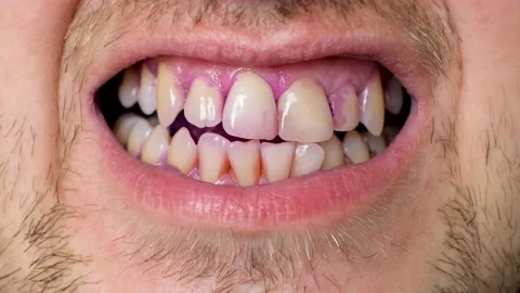 Plaque on human teeth is colored pink wi... | Stock Video | Pond5