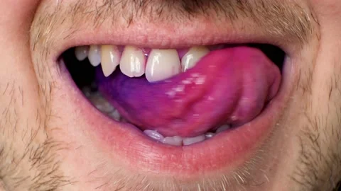 Plaque on human teeth is colored pink wi... | Stock Video | Pond5