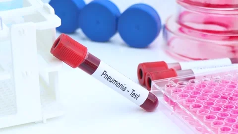 Pneumonia test to look for abnormalities... | Stock Video | Pond5