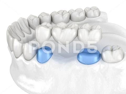 Porcelain Dental bridge of 3 teeth over molar and premolar. ~ Clip Art ...