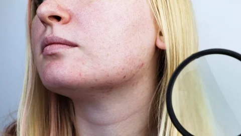 Acne Scars Stock Videos – Royalty-Free HD & 4K Videos