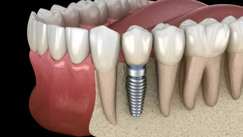 Recovery N Stock Videos – Royalty-Free HD & 4K Videos | Pond5