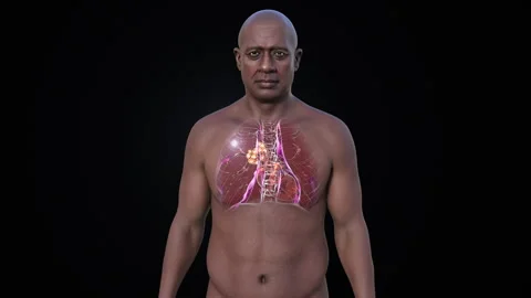 Primary lung tuberculosis causing Ghon c... | Stock Video | Pond5