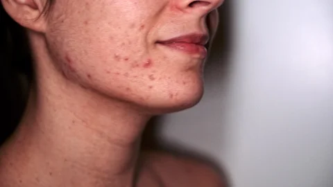 Problematic Skin - Portrait of Young Wom... | Stock Video | Pond5