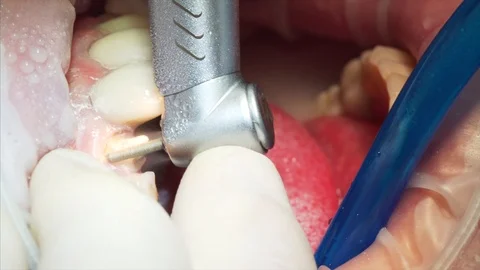 Process of drilling an old tooth before ... | Stock Video | Pond5