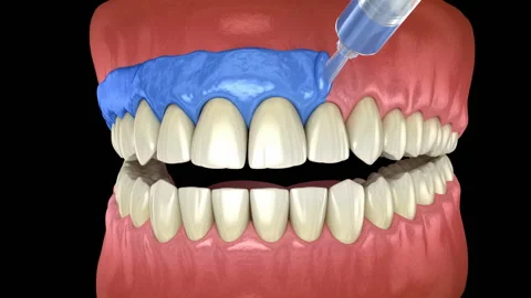 Proffesioinal teeth whitening, light-act... | Stock Video | Pond5