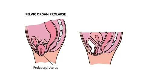 PROLAPSED BLADDER RECTUM UTERUS Of Women... | Stock Video | Pond5