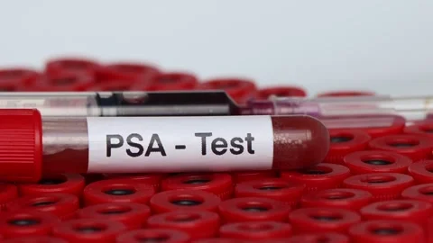 PSA test to look for abnormalities from ... | Stock Video | Pond5