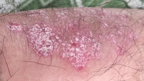 Psoriasis, Plaque psoriasis, Pustular ps... | Stock Video | Pond5