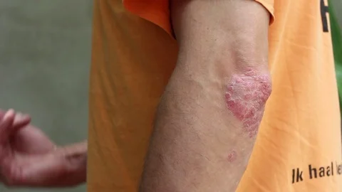 Plaque Psoriasis Stock Footage ~ Royalty Free Stock Videos | Pond5