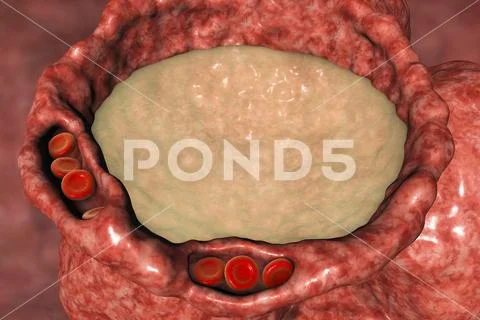 Pulmonary edema, close-up view of alveolus cross-section showing liquid ...