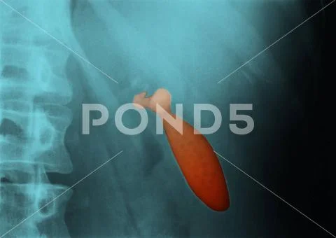 Photograph: Radiation cholelithiasis The gallbladder is invaded by a ...