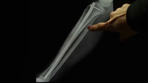Broken Leg Xray Stock Videos – Royalty-Free HD & 4K Videos