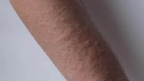 Rash on the arm, urticaria, allergies, s... | Stock Video | Pond5
