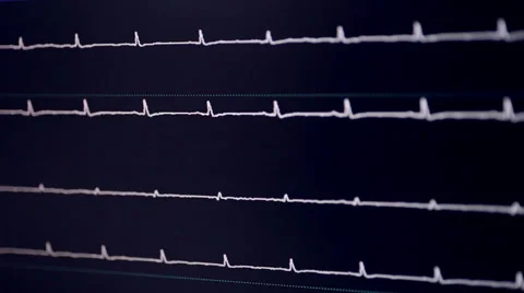 Real Cardiogram. Working cardiograph in ... | Stock Video | Pond5