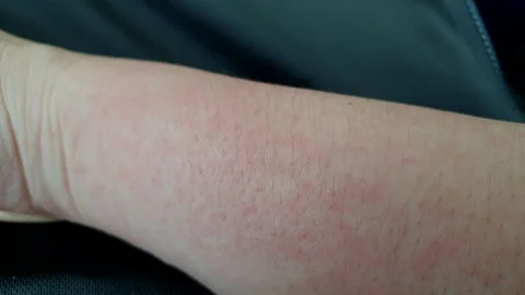 Red blood rash spots on skin dengue feve... | Stock Video | Pond5