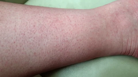 Red blood rash spots on skin dengue feve... | Stock Video | Pond5
