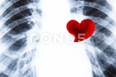 Red heart on the background of chest X-ray. Concept of heart attack ...