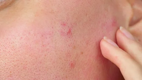 Skin Inflammation Stock Videos – Royalty-Free HD & 4K Videos