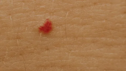 red moles on the patient s skin, hemangi... | Stock Video | Pond5