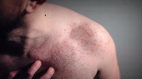 Red pimples on the skin of unrecognisabl... | Stock Video | Pond5
