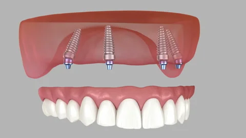 Removable prosthesis supported by four i... | Stock Video | Pond5