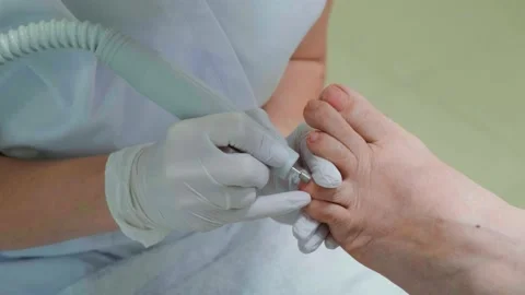 removal of fungus from the patient's toe... | Stock Video | Pond5
