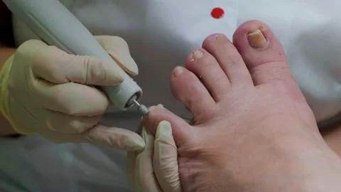 removal of fungus from the patient's toe... | Stock Video | Pond5