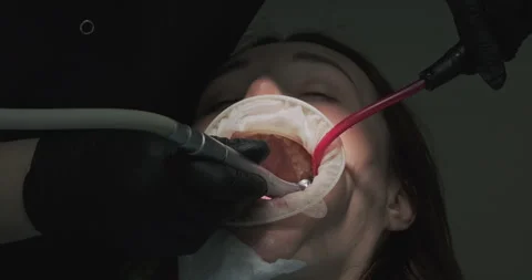 Removal of plaque with a scaler, saliva ... | Stock Video | Pond5