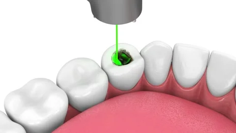 Removing tooth decay with dental laser w... | Stock Video | Pond5