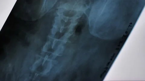 Rengen a close-up of the x-ray spine, sp... | Stock Video | Pond5