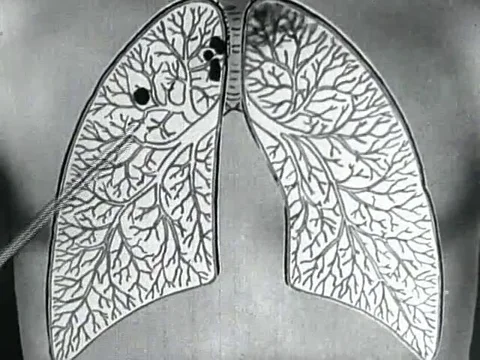 Representation of lungs affected by tube... | Stock Video | Pond5