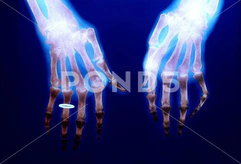 Rheumatoid arthritis, x-ray Rheumatoid arthritis is an inflammatory ...