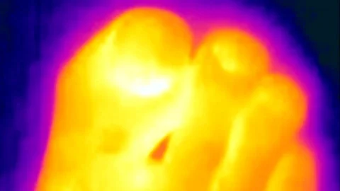 Right Foot Closeup With Big Toes Medical... | Stock Video | Pond5