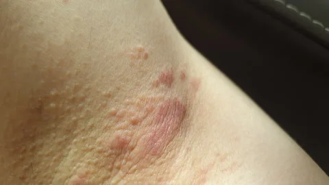 ringworm eczema infected on human body r... | Stock Video | Pond5