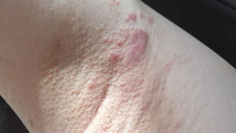 ringworm eczema infected on human body r... | Stock Video | Pond5