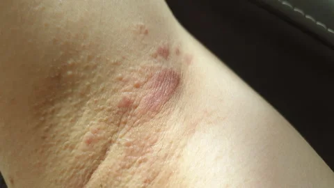 ringworm eczema infected on human body r... | Stock Video | Pond5